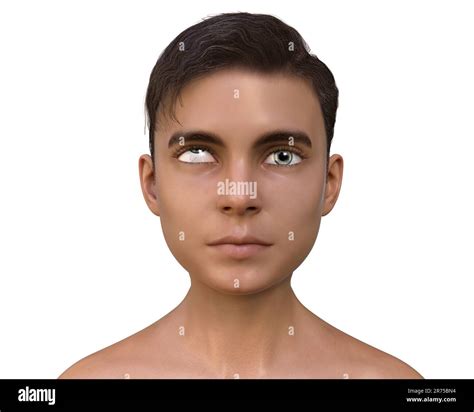 Illustration Of Hypertropia A Form Of Vertical Strabismus Where There