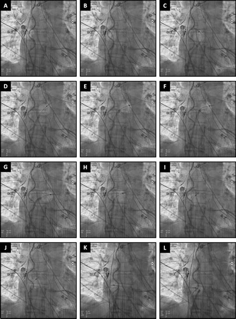 Bipolar Voltage Map At Redo Procedure In A Patient With Left Atrial