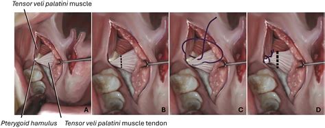Tensor Veli Palatini Muscle Tenopexy During Furlow Palatoplasty Fails