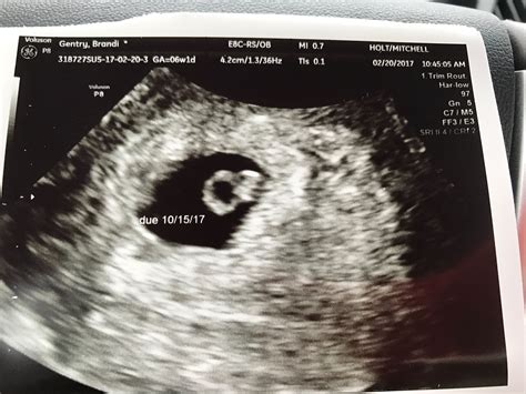 6 Weeks Pregnant Sonogram Hiccups Pregnancy
