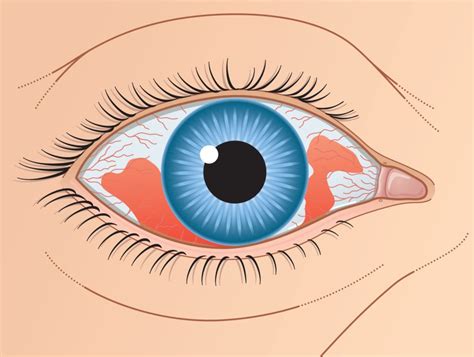 Common Eye Disorders Ento Key