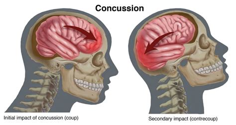 Understanding Concussions Sports Medicine