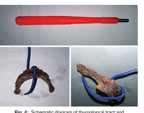 Figure 1 From Modified Sistrunk Procedure A Novel Method Of Hyoid Resection Using Skin Punches