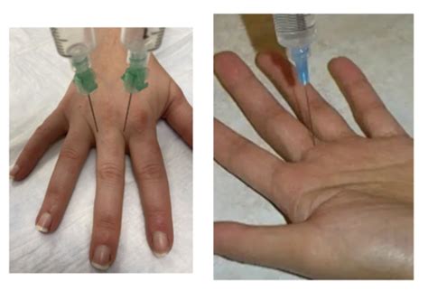 Digital Block Eclipse Biopsy Staple Applicationremoval Flashcards