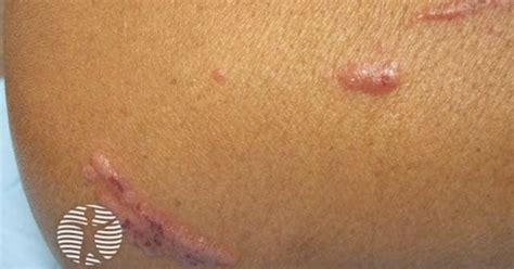 Plant Dermatitis Image