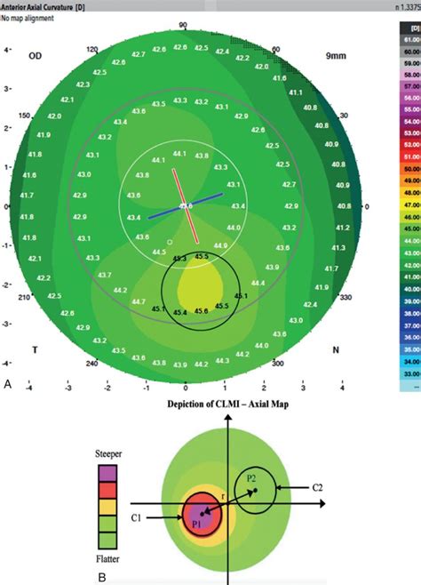 Corneal Topography In Keratoconus Ento Key
