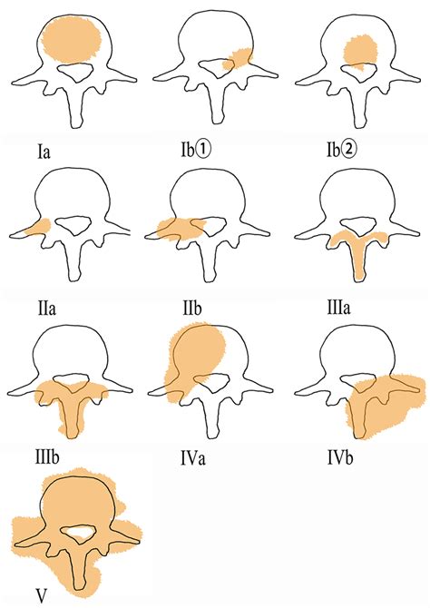 Classification Of Metastatic Spinal Malignancies Download Scientific