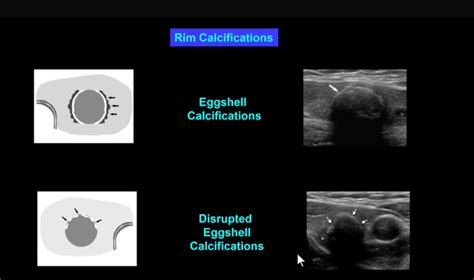 Thyroid Nodules With Eggshell Calcifications Rodrigo Arrangoiz Ms Md Facs Fsso