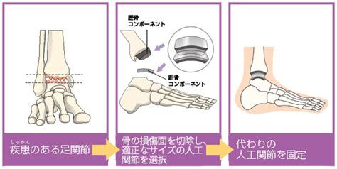 人工足関節置換術とは人工足関節について人工関節とは人工関節ドットコム