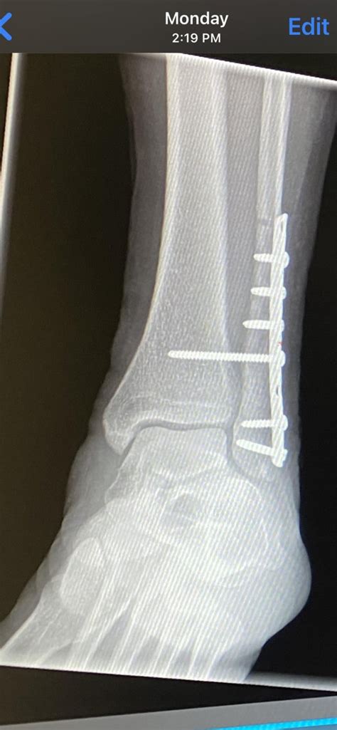 Almost 7months Post Op What Is Happening R Orif