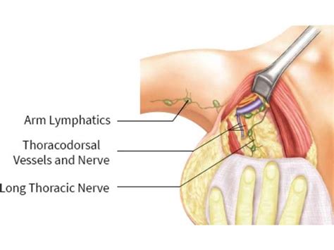 Lymph Node Dissection Daken Life Science Technology Limited