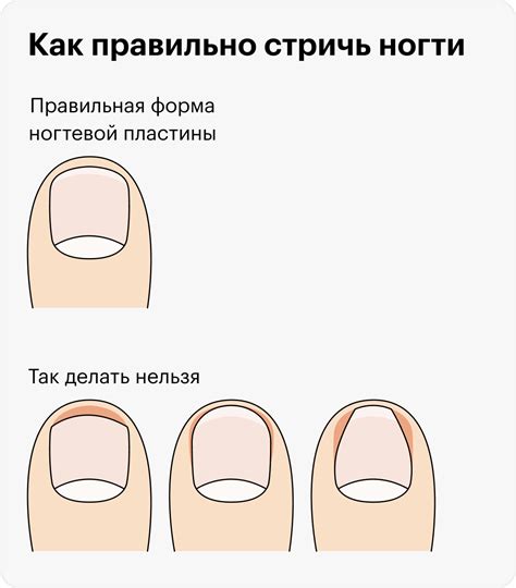 Вросший ноготь: что делать, причины, лечение без операции, осложнения ...