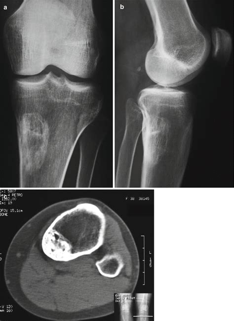 Metaphyseal Fibrous Defect Musculoskeletal Key