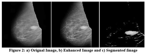 A Hybrid Model For The Segmentation Of Mammogram Images Using Otsu