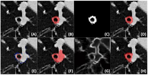 A Original Image B Binary Segmentation For Rfc Method C