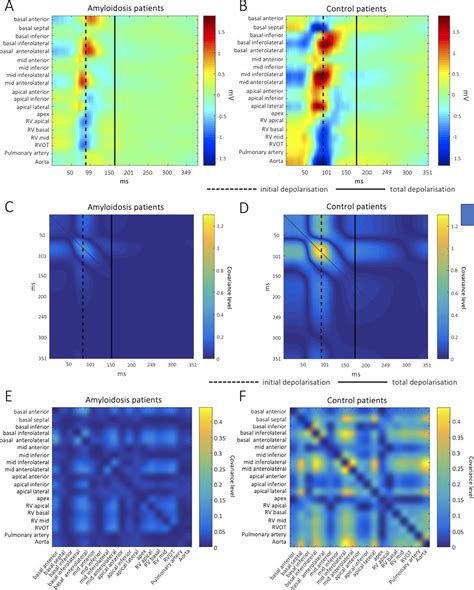 Machine Learning Derived Electrocardiographic Algorithm For The Detection Of Cardiac Amyloidosis
