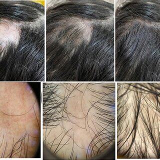 Female Patient 25 Years Old With Scalp AA Patch Treated With Topical Download Scientific