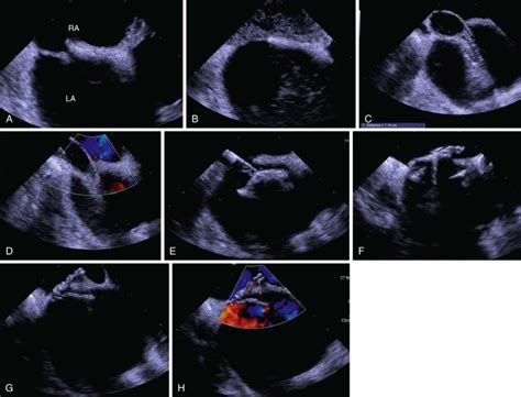 Patent Foramen Ovale Atrial Septal Defect Left Atrial Appendage And