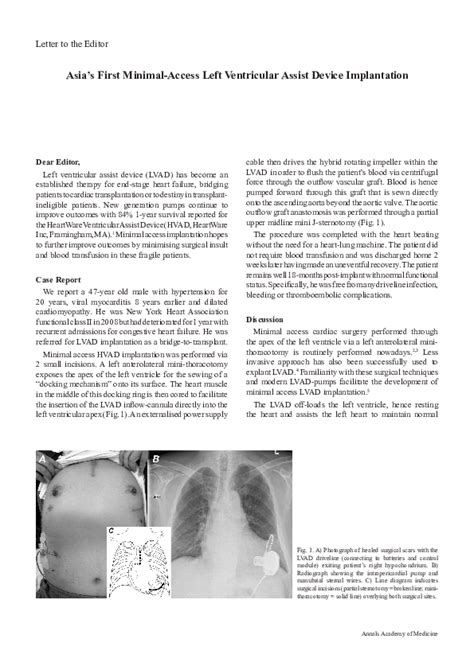 Pdf Asias First Minimal Access Left Ventricular Assist Device