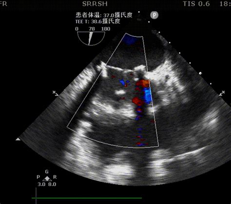 杰出妙计·双瓣病例｜浙江邵逸夫医院钱希明教授团队应用j Valve完成1例tavrtmvr 严道医声网