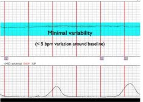 Fetal Monitoring Flashcards Quizlet