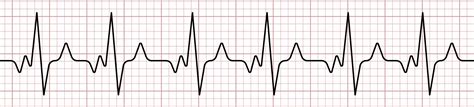 Topic Pulseless Electrical Activity Pea Acls Ep Course Acls
