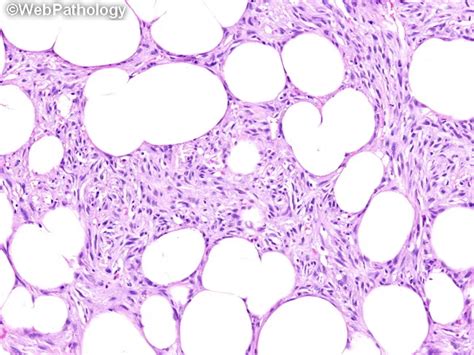 Spindle Cell Lipoma Introduction