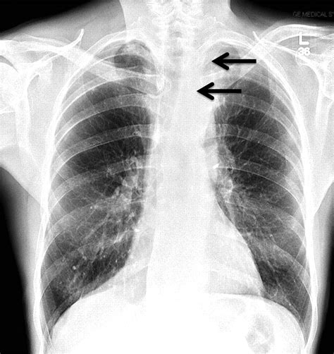 Pancoast Tumour Bmj Case Reports