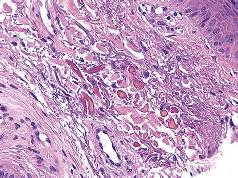 Patchy Facial Hyperpigmentation Actas Dermo Sifiliográficas