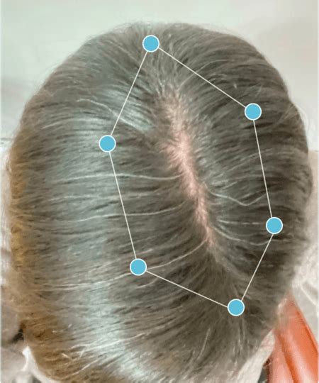 Mdhair Custom Hair Growth Treatment