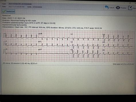 63 Yo In Svt Converted Via Modified Valsalva Maneuver Recg