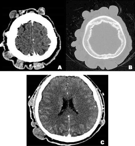 Rbcp Tumor Resection And Partial Skin Graft Placement On The Scalp In