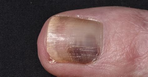 갑자기 생긴 발톱 ‘멍 암일 수 있다고