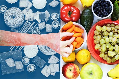 Is There A Diet For Psoriasis