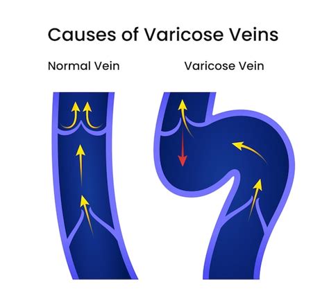 Premium Vector Causes Of The Varicose Veins