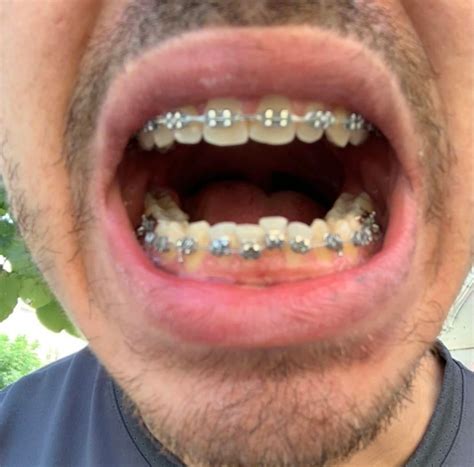 Weird Comparison Upper Teeth Before Braces Vs 6 Months In Is It Just