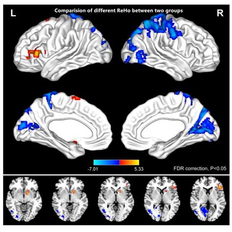 Regional Homogeneity Method Applied In Ophthalmological Diseases Download Scientific Diagram