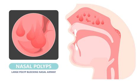 Treatment Options Las Vegas Nv Sinus Treatment Las Vegas