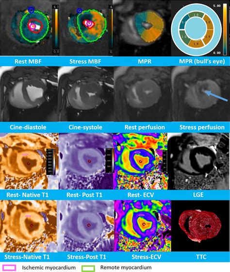 Detection Of Myocardial Ischemia Using Cardiovascular Mri Stress T1 Mapping A Miniature Swine