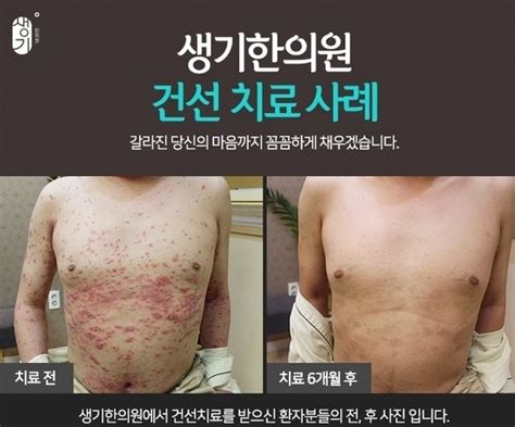 노원건선치료 생기한의원 노원점