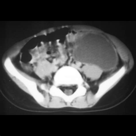 Newborn With Palpable Lower Abdominal Mass Pediatric Radiology Case