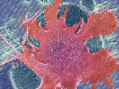 Bone Cancer Stock Image C057 3761 Science Photo Library