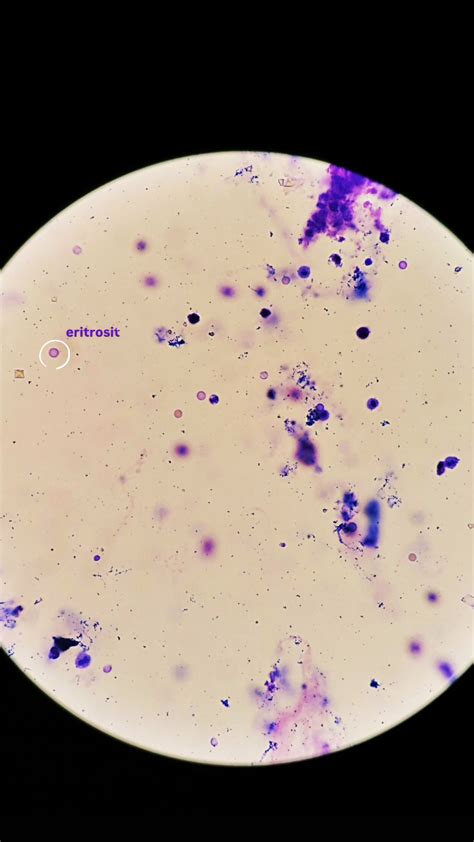 Amila Thursina Hilyah On Linkedin 👩‍🔬 Kemunculan Sel Eritrosit Dan Leukosit Pada Urine Pasien 🔎 🔍…