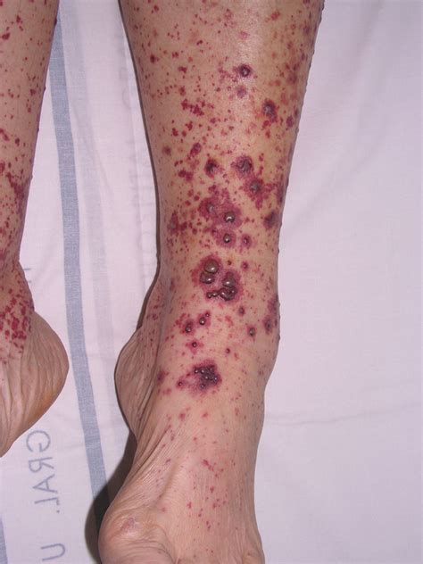 Vasculitis Cutáneas Actas Dermo Sifiliográficas