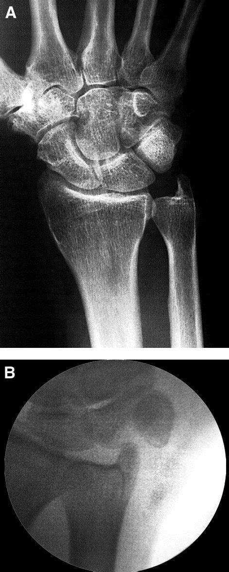 Arthroscopic Excision Of Ulnar Styloid In Stylocarpal Impaction