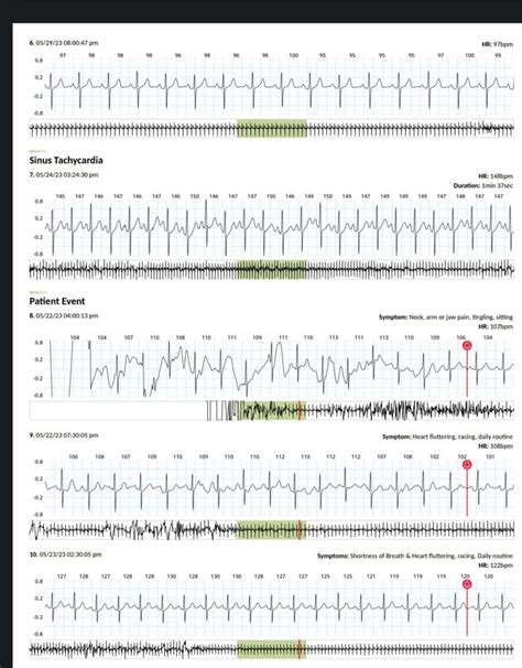 Heart Palps Tachycardia Presyncope Extreme Fatigue For Months No