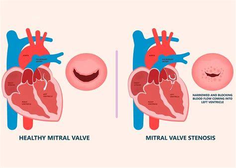 Mitral Stenosis Treatment In Hyderabad Drsudheer