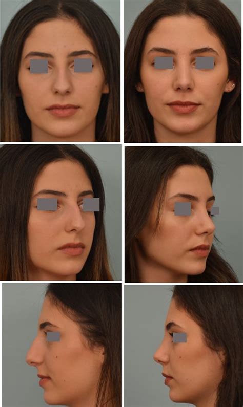 Rhinoplasty Glasgow Nose Job Nose Surgery Scotland Artofit