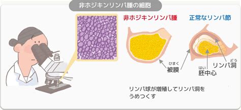 非ホジキンリンパ腫の特徴 リンパ腫のお話