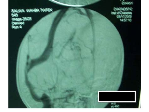 Digital Subtraction Cerebral Angiography Venous Phase Oblique View